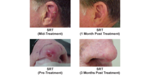 Superficial Radiation Therapy (SRT) - Mid-Atlantic Skin Surgery Institute