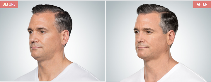 How to Effectively Remove the Fullness Under Your Chin - Mid-Atlantic ...