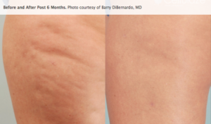 Cellulaze - Mid-Atlantic Skin Surgery Institute