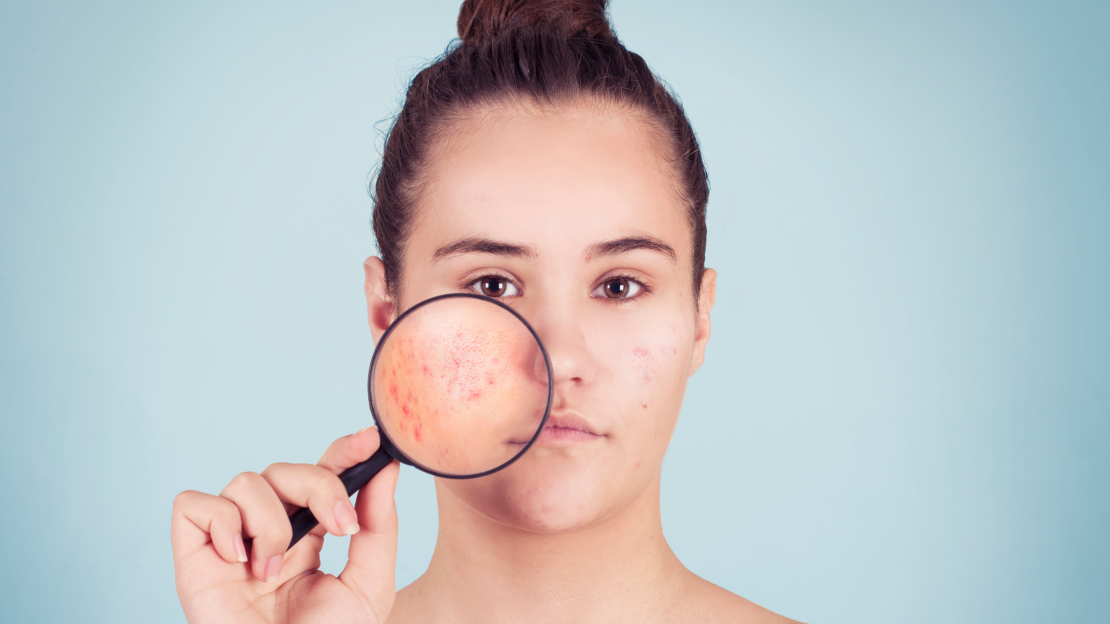How to Find the Best Acne Doctor - Mid-Atlantic Skin Surgery Institute