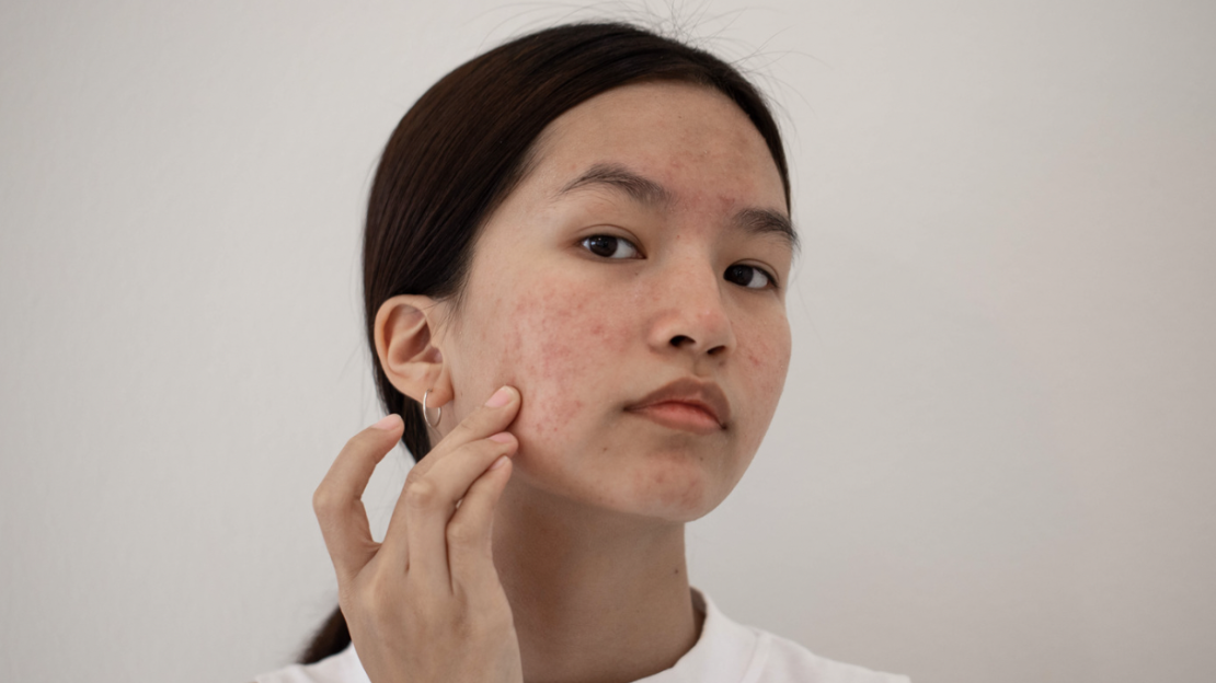 Choosing the Best Acne Doctor in California MD - Mid-Atlantic Skin ...