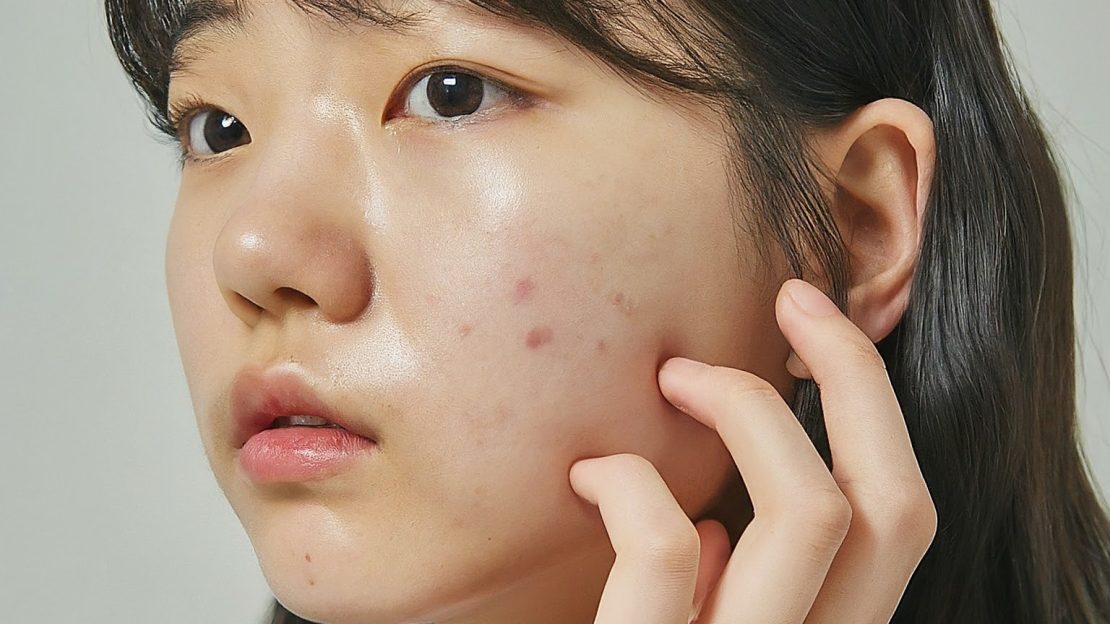 5 Simple Steps to Find the Best Acne Doctor in Prince Frederick ...