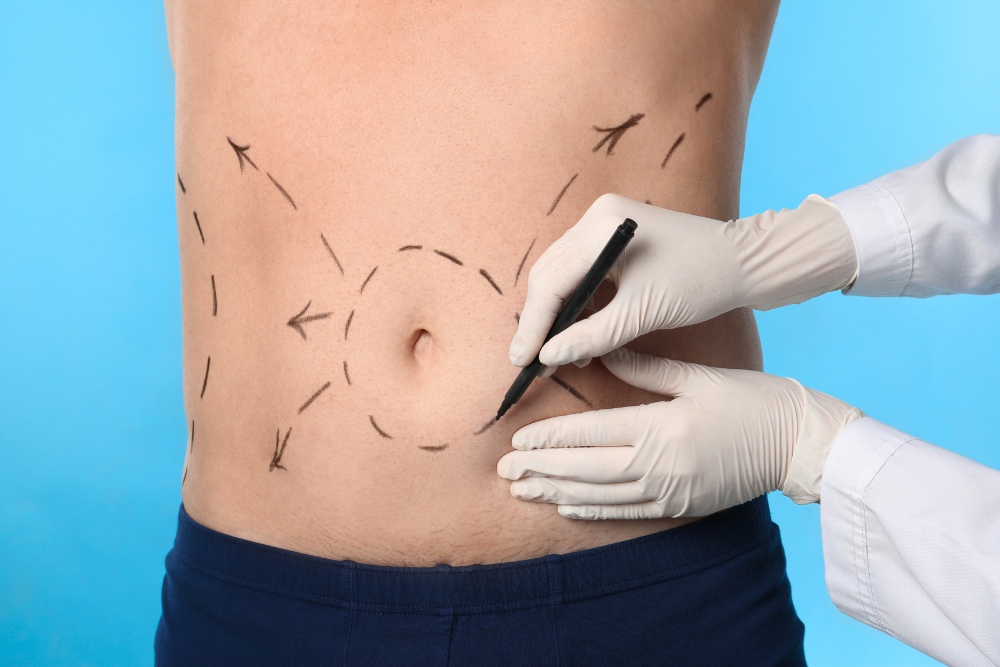 Exploring Liposuction Options in Waldorf, MD for Body Contouring - Mid ...