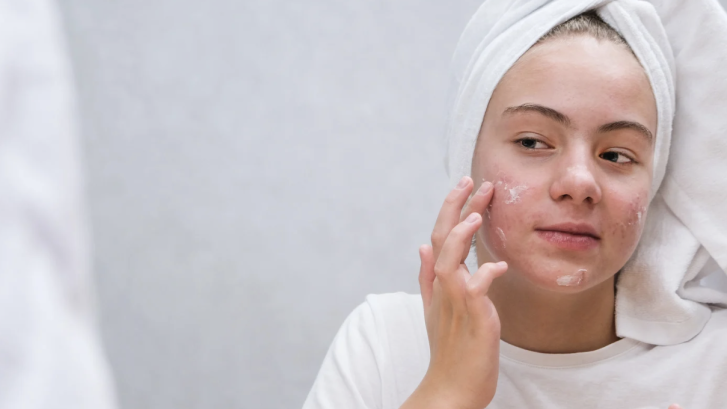 Dermatology Appointment for Acne Near Prince Frederick MD Archives ...