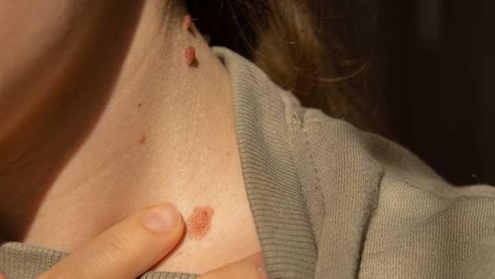 5 Things to Know About GentleCure Skin Cancer Treatment in Maryland ...