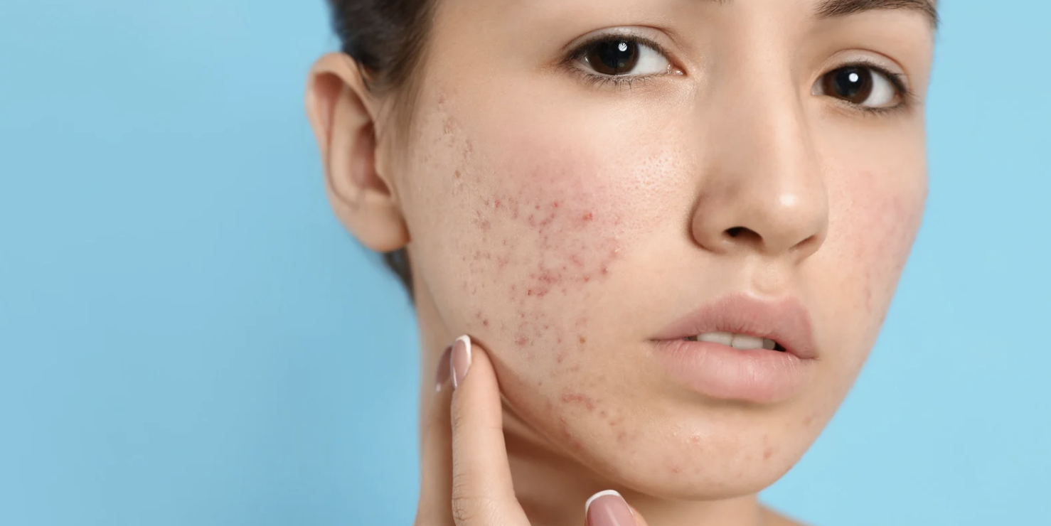 Same-Day Acne Appointment Near California, Maryland - Mid-Atlantic Skin ...