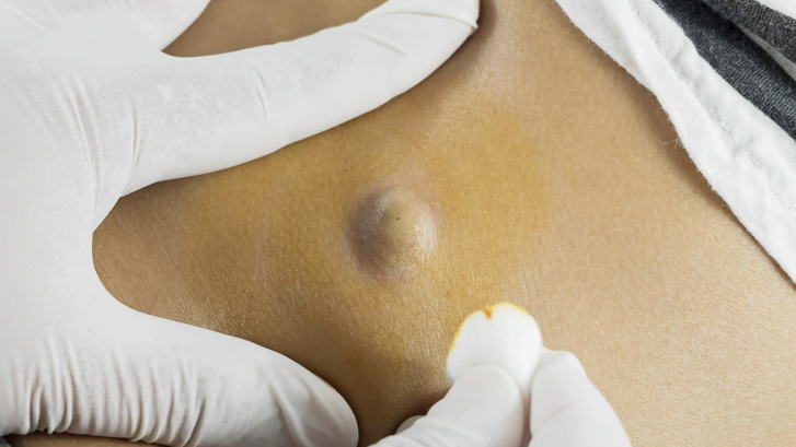 Cyst removal Appointments in Solomons, Maryland - Mid-Atlantic Skin ...
