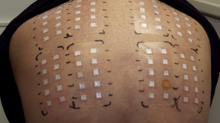 Allergy Patch Testing Dermatology Appointment in North Beach, Maryland ...
