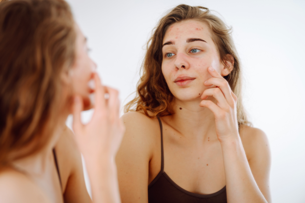 What's New for Winter Acne Treatment Appointments in Prince Frederick ...